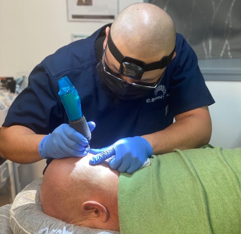 Why Do Some SMP Treatments Look Fake or Botched Up? | Elegant SMP