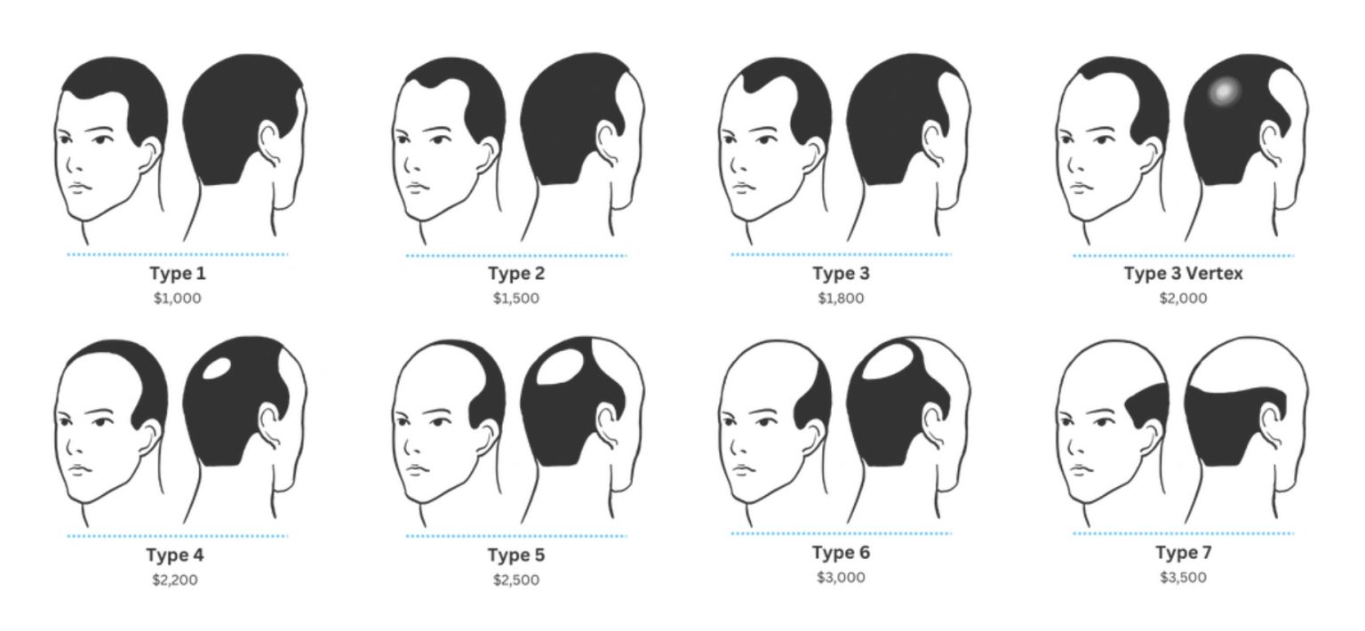 Male Pattern Baldness | Elegant SMP
